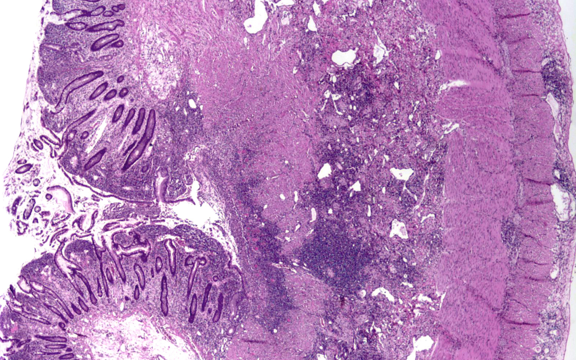 Crohns Disease Patient Resource Ascp Patient Champions